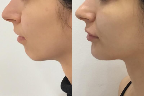 Dermal Fillers - Concept Derma Clinic