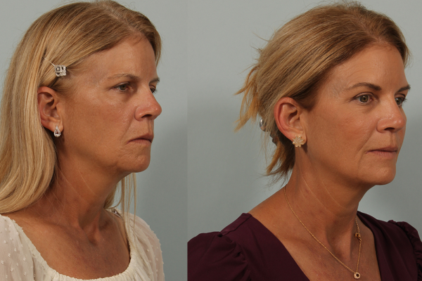 Dermal Fillers - Concept Derma Clinic