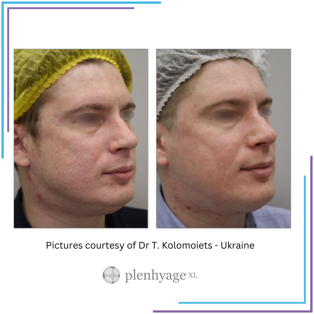 Plenhyage XL - Concept Derma Clinic