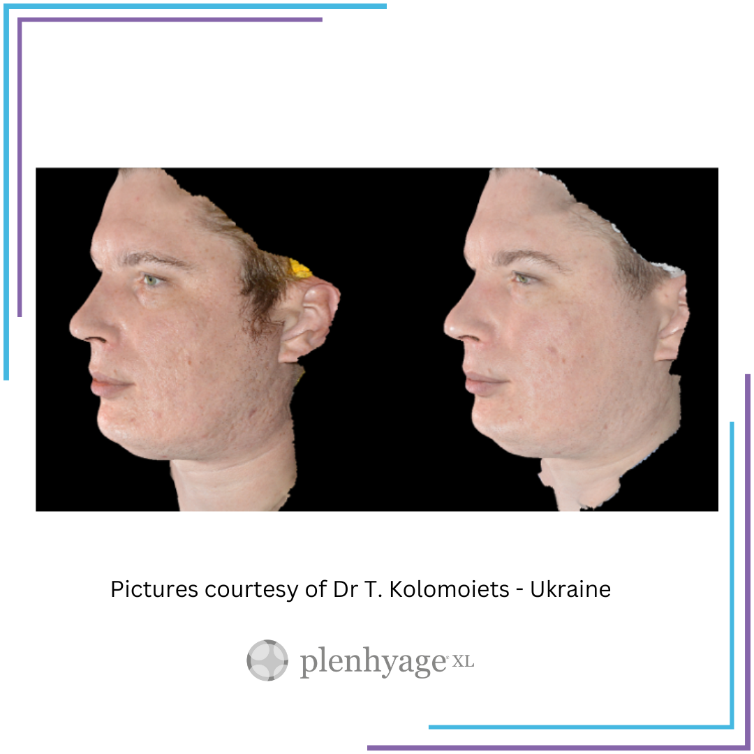 Plenhyage XL - Concept Derma Clinic