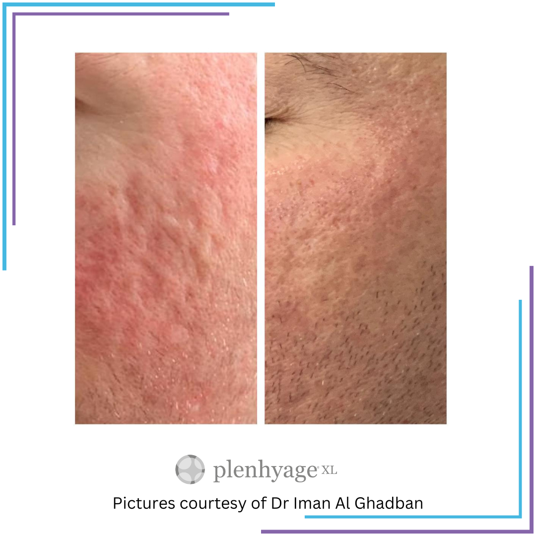 Plenhyage XL - Concept Derma Clinic