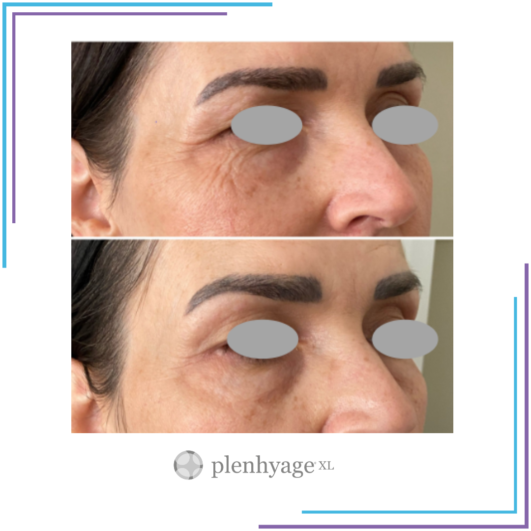 Plenhyage XL - Concept Derma Clinic